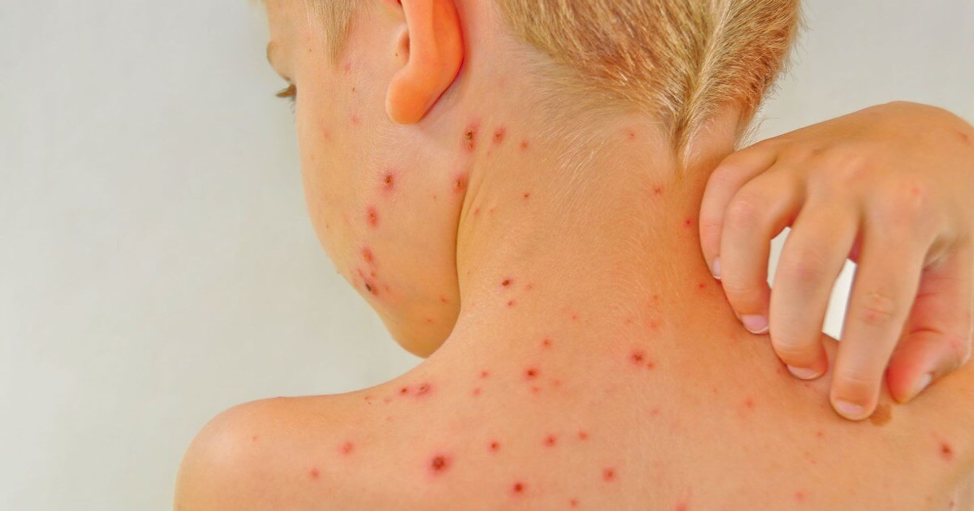 ¿Cómo se contagia la varicela? - pasalo.es